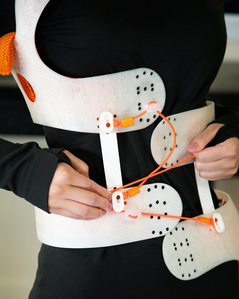 ‘airy’ scoliosis brace is designed for young girls to wear with comfort ...
