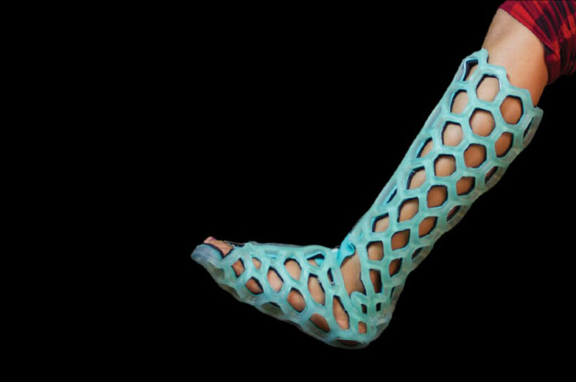 washable & breathable flexiOH cast adapts to the patient's skin